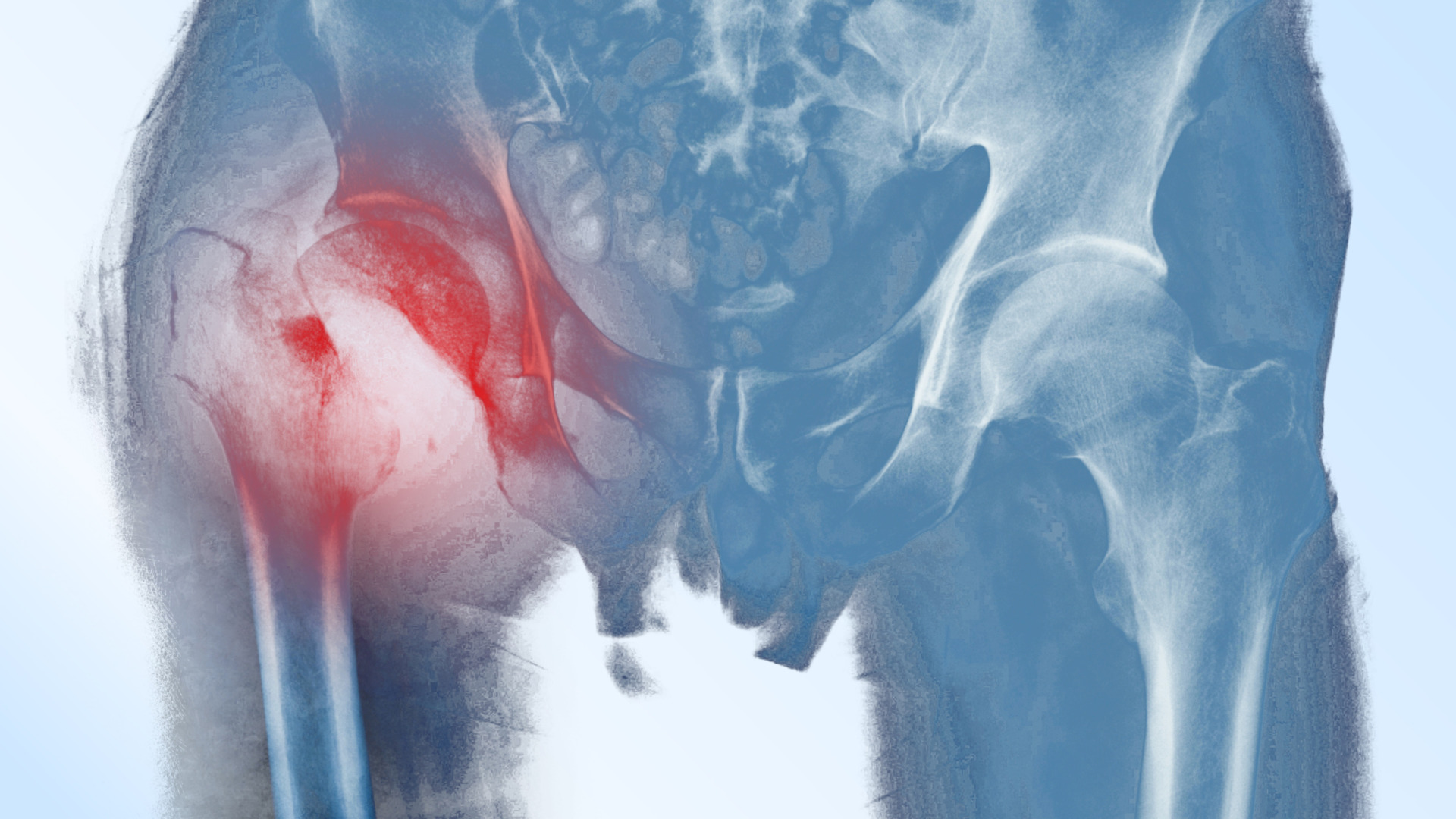 Dor na anca | Exercícios. Qual o melhor tratamento existe?